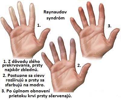 Syndróm studených rúk a nôh alebo Raynaudov syndróm. | Dixo.sk